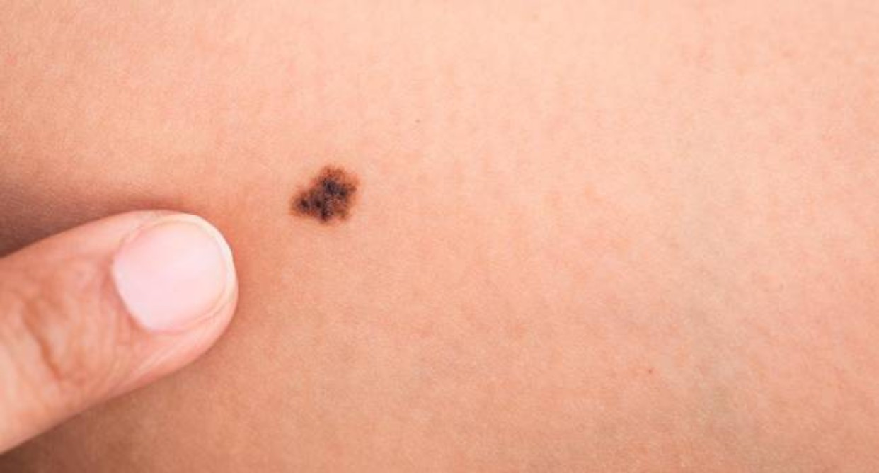 Cambios en lunares pueden ser signos de melanoma